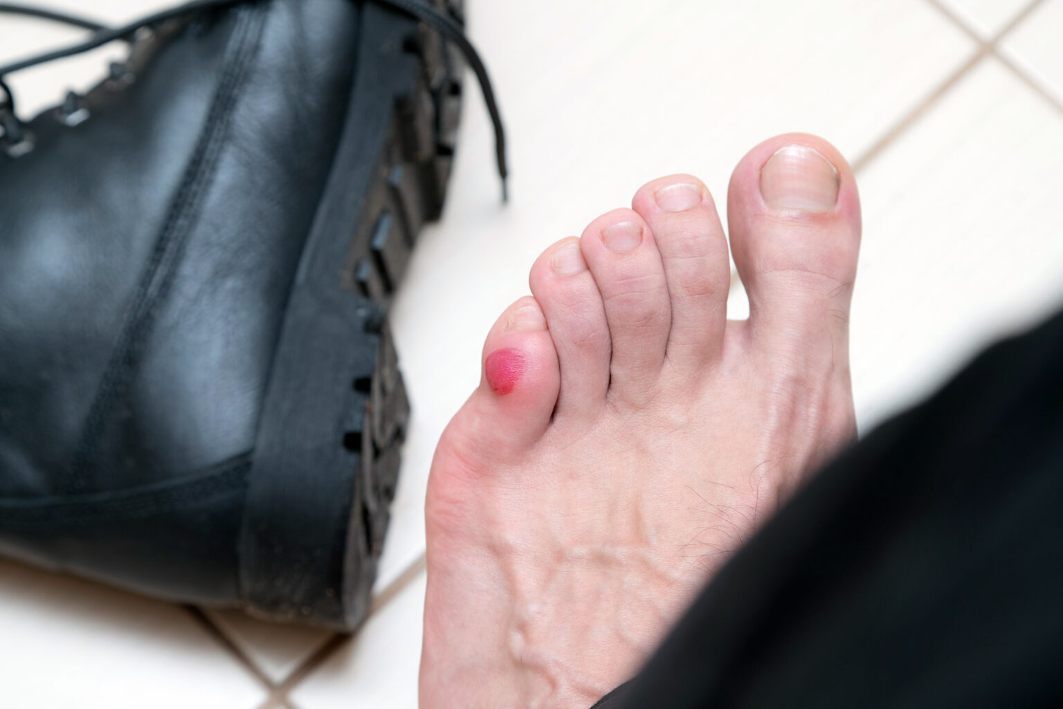 Blisters | Foot | Foot Doctor | Foot Pain | Marion County | Sumter County